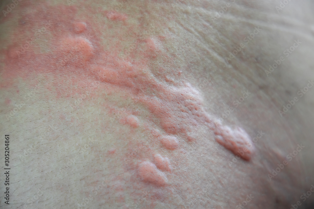 urticaria on skin. rashes, of which urticaria and toxic erythema are ...