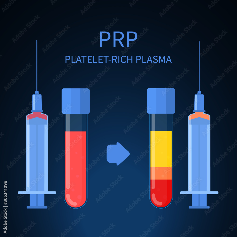 PRP procedure steps vector infographics. Test tubes and syringes filled ...