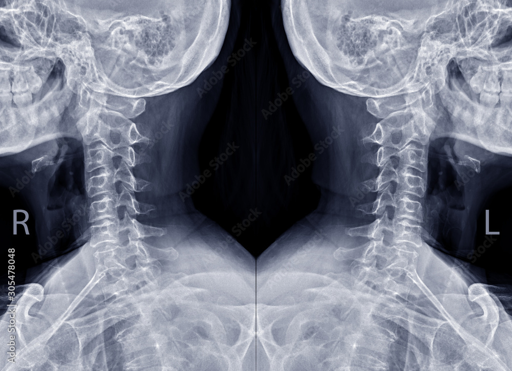 Collection of X-ray C-spine or x-ray image of Cervical spine oblique ...