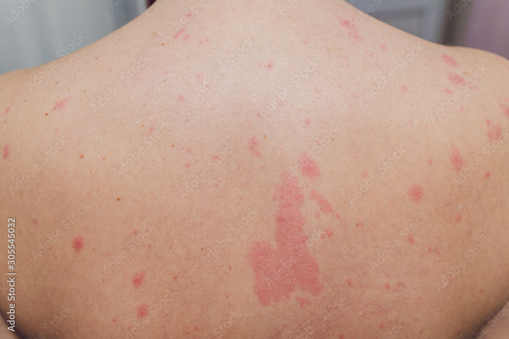 Close up Allergy rash, Around Back view of human with dermatitis ...