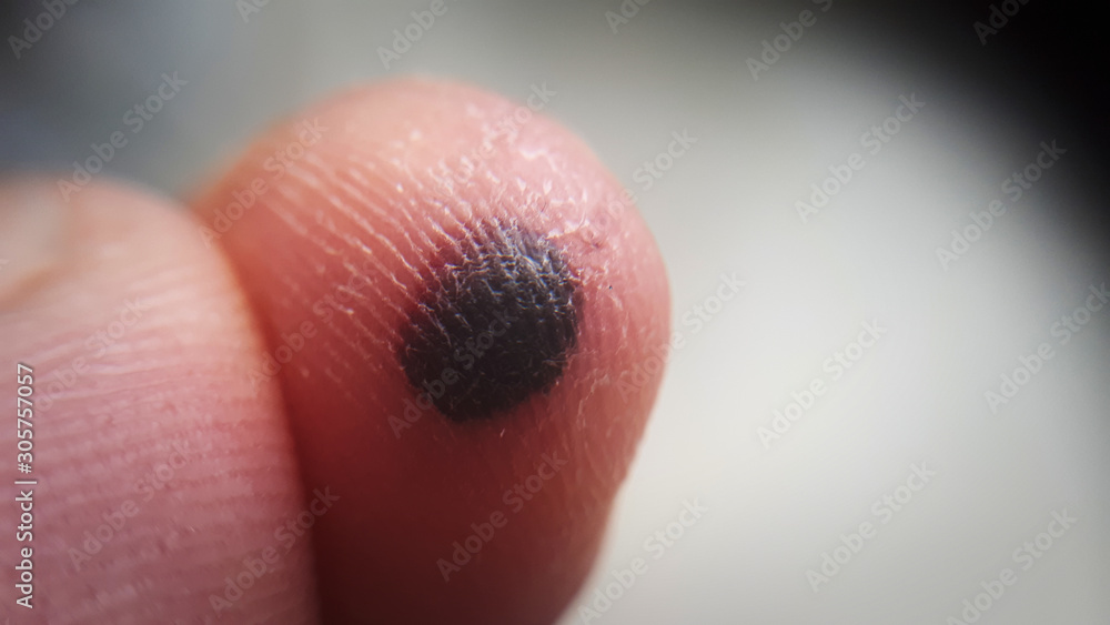 Macro hematoma on a finger after being hit with a hammer. Stock Photo ...