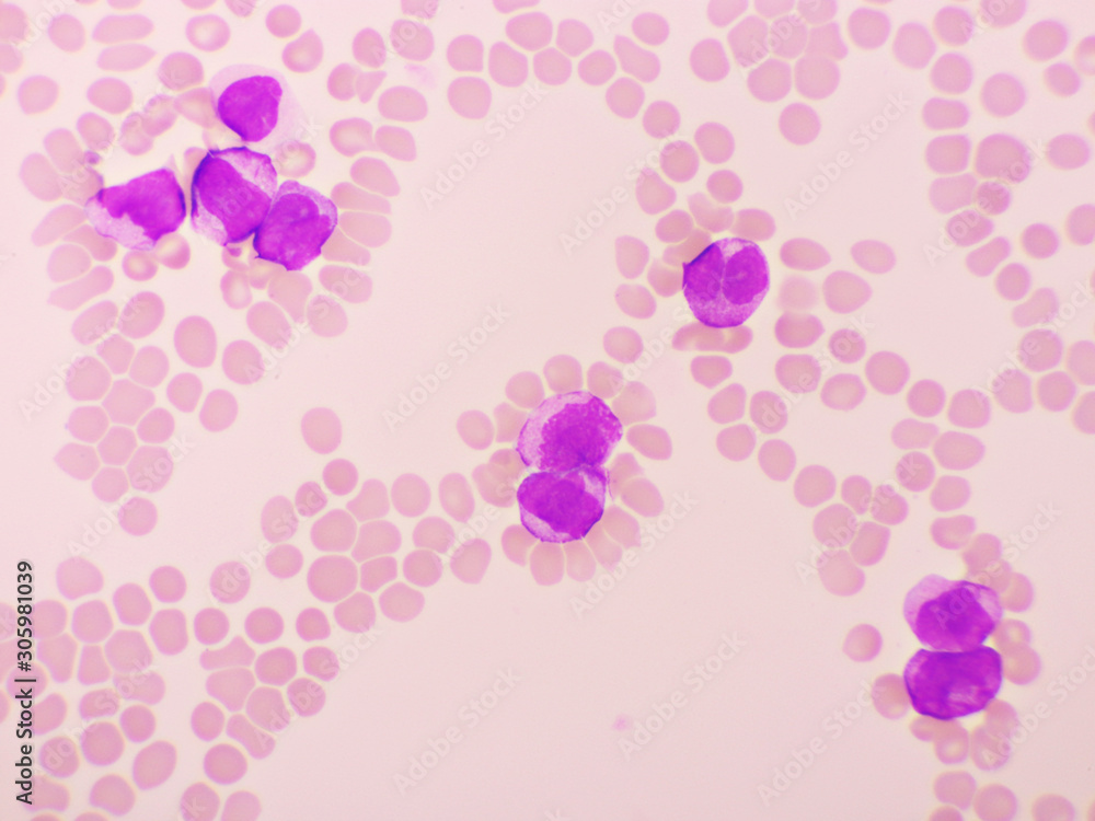 Acute promyelocytic leukemia cells or APL, analyze by microscope ...