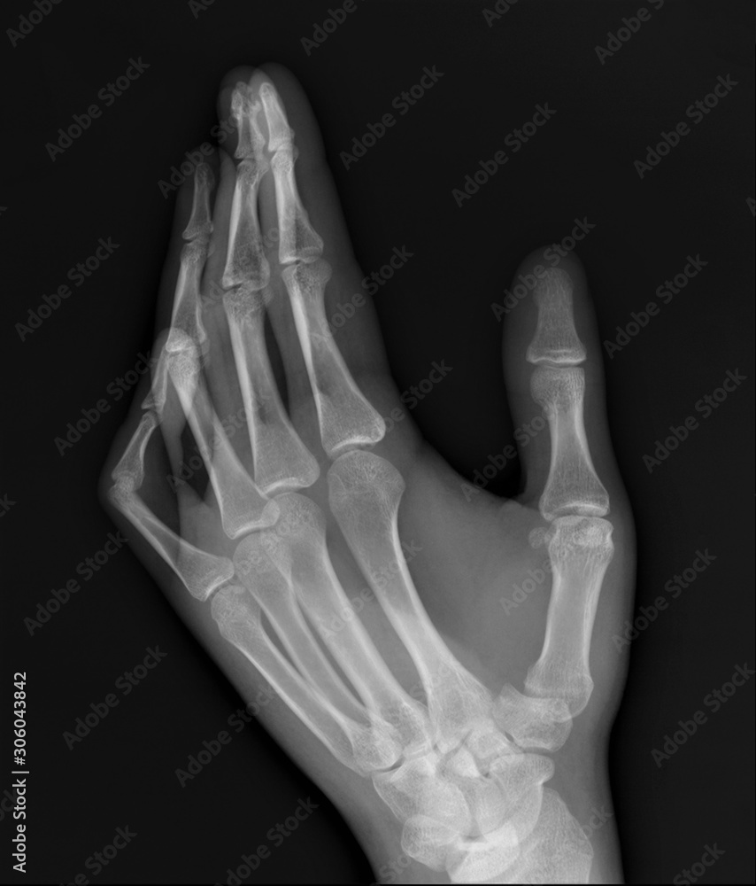 normal x-ray of the hand bones and fingers,orthopedics, medical ...