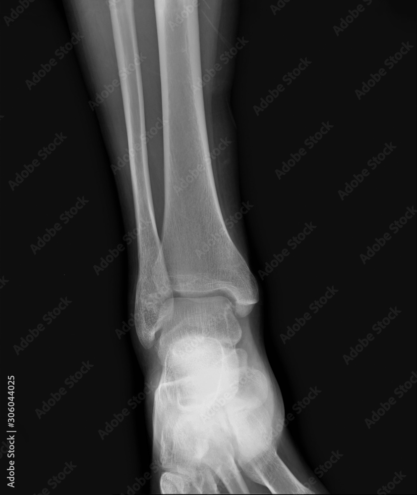 Normal Ray X Ankle Joint