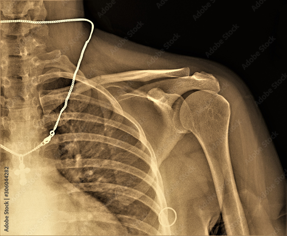 normal radiography of the shoulder joint in direct projection ...
