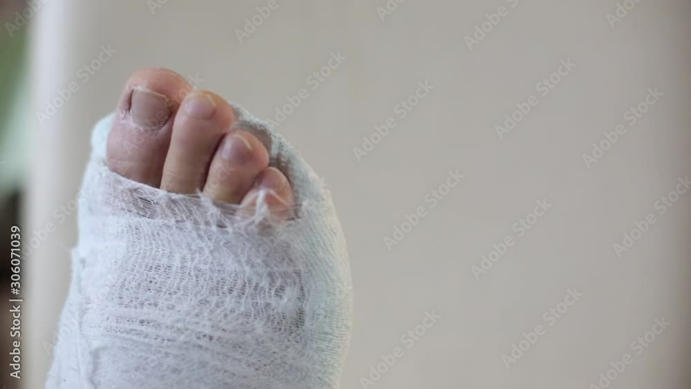 Vidéo Stock male leg in a plaster cast. toes moving. plain background ...