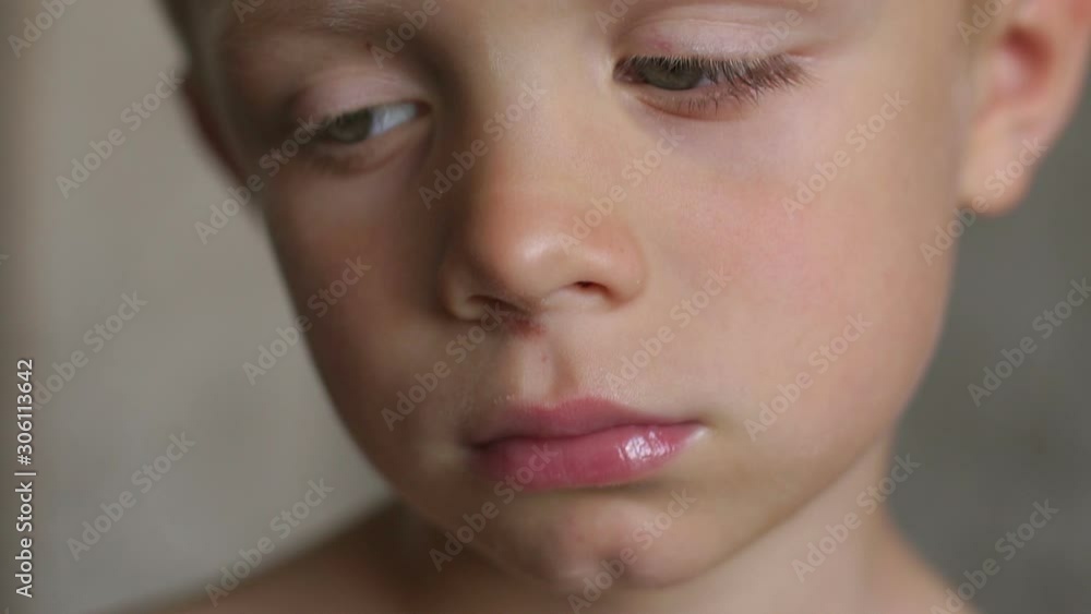 Close-up face of a little boy with a scratched nose. The child fell and ...