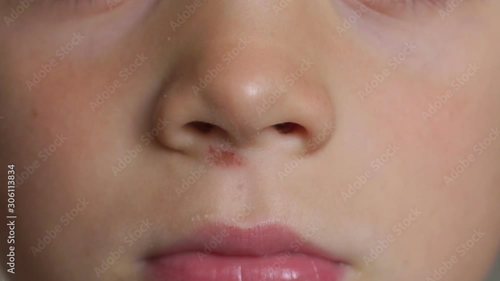 Close-up face of a little boy with a scratched nose. The child fell and ...