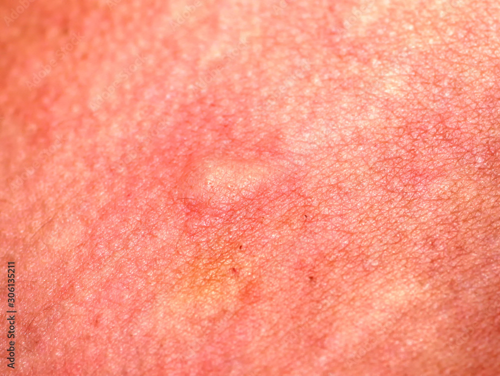 Inflamed skin eczema, psoriasis, seborrhea. Skin inflammation. Stock ...