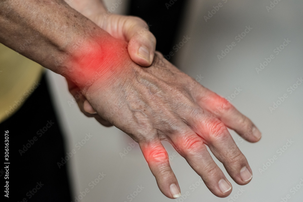 Overuse hand problems. Woman’s hand with red spot o fingers as suffer ...