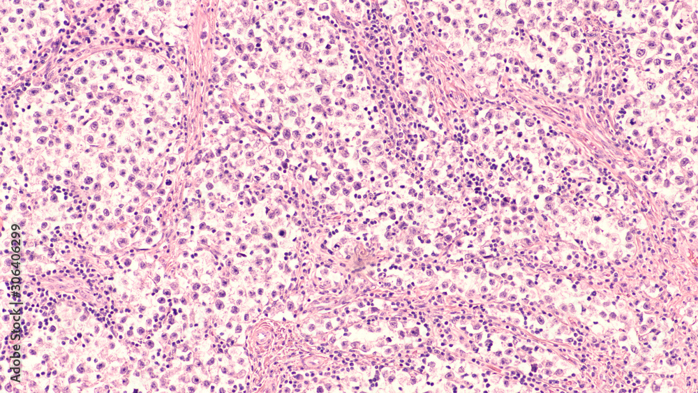 Testicular Cancer Photomicrograph Of Seminoma A Malignant Germ Cell