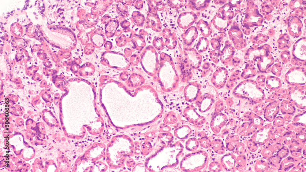 Photomicrograph of a fundic gland polyp, a benign polyp of the stomach ...