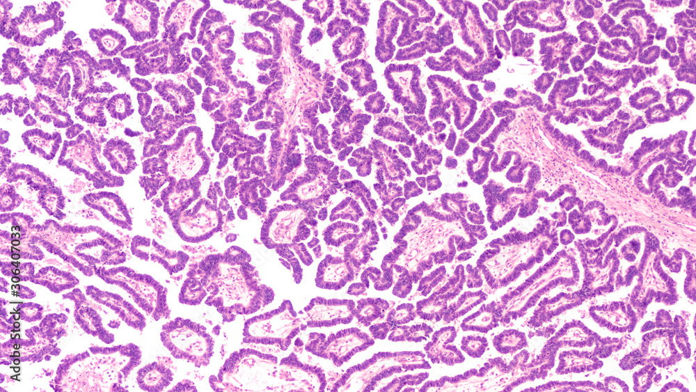 Ovarian Cancer Awareness: Micrograph of a serous papillary carcinoma ...