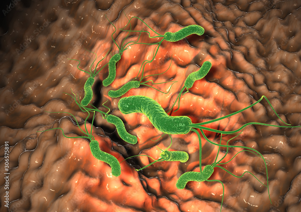 Gastritis, helicobacter pylori in stomach, medically accurate 3D ...