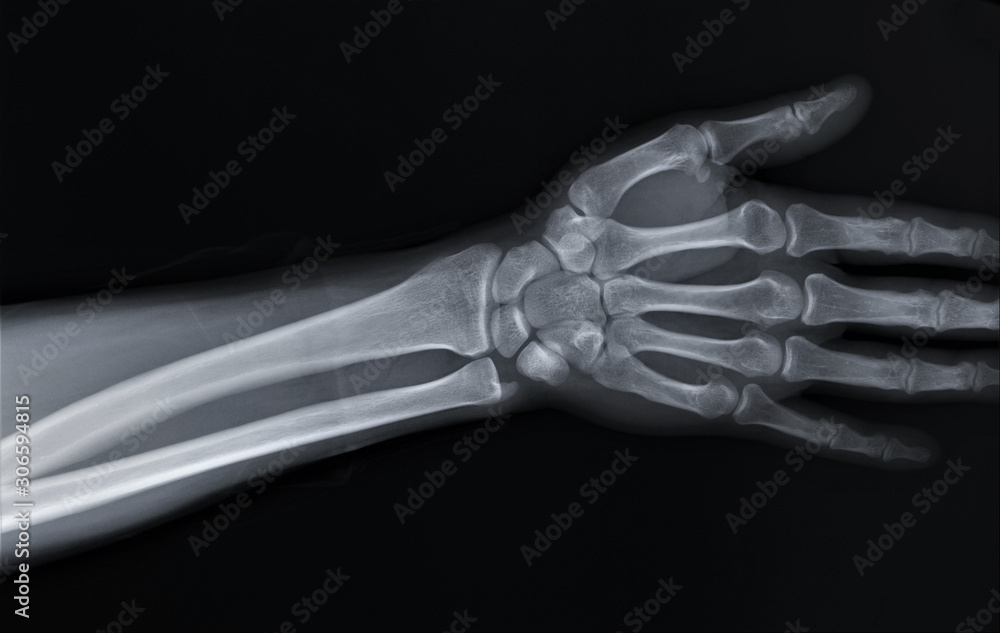 normal radiography of hand and wrist bones, traumatology and ...
