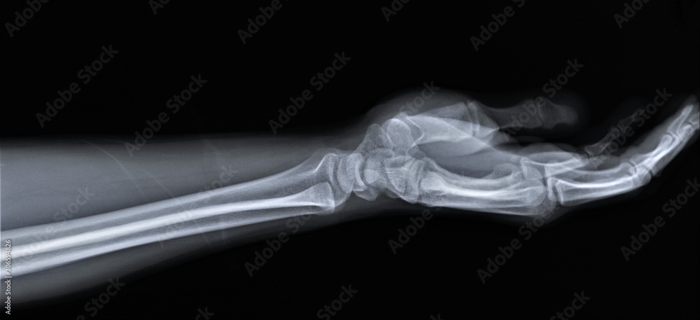 normal radiography of hand and wrist bones, traumatology and ...