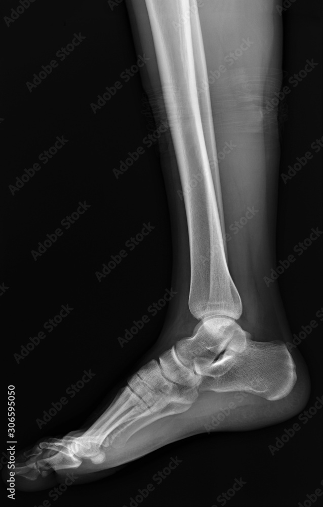 normal radiograph of the ankle joint Stock Photo | Adobe Stock