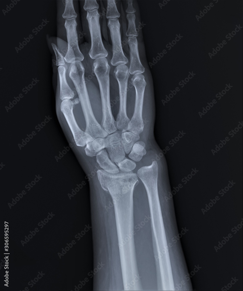 radiography of forearm and wrist bones with a fracture of the distal ...