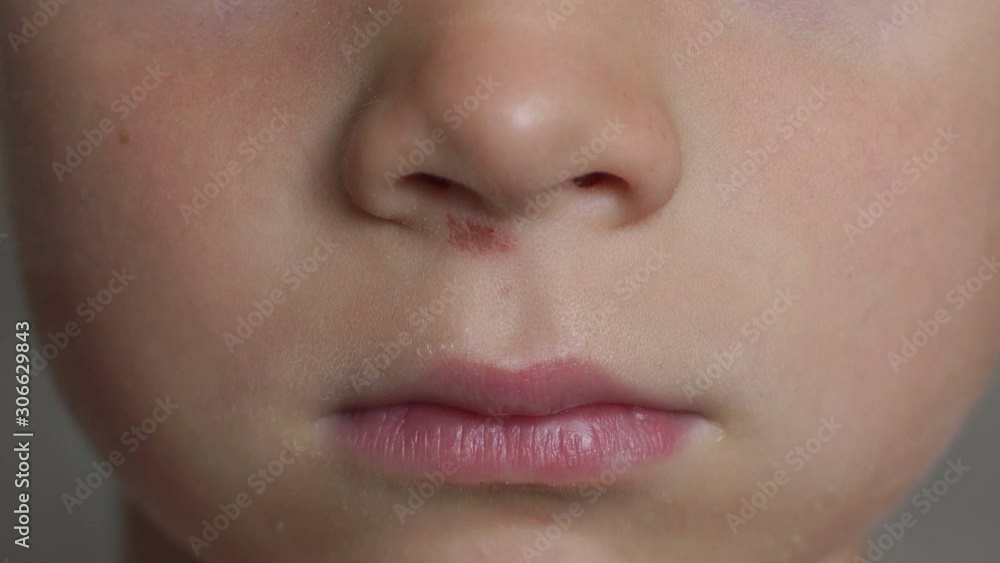 Close-up face of a little boy with a scratched nose. The child fell and ...
