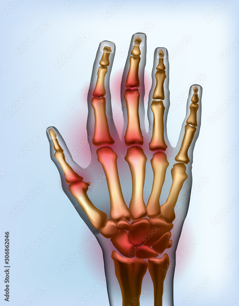Frontal view image sore osteoarthritis joints of bones the of hand ...