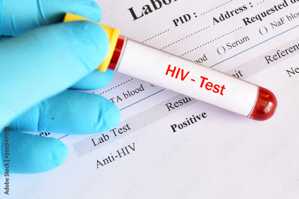 HIV positive test result with blood sample tube Stock Photo | Adobe Stock