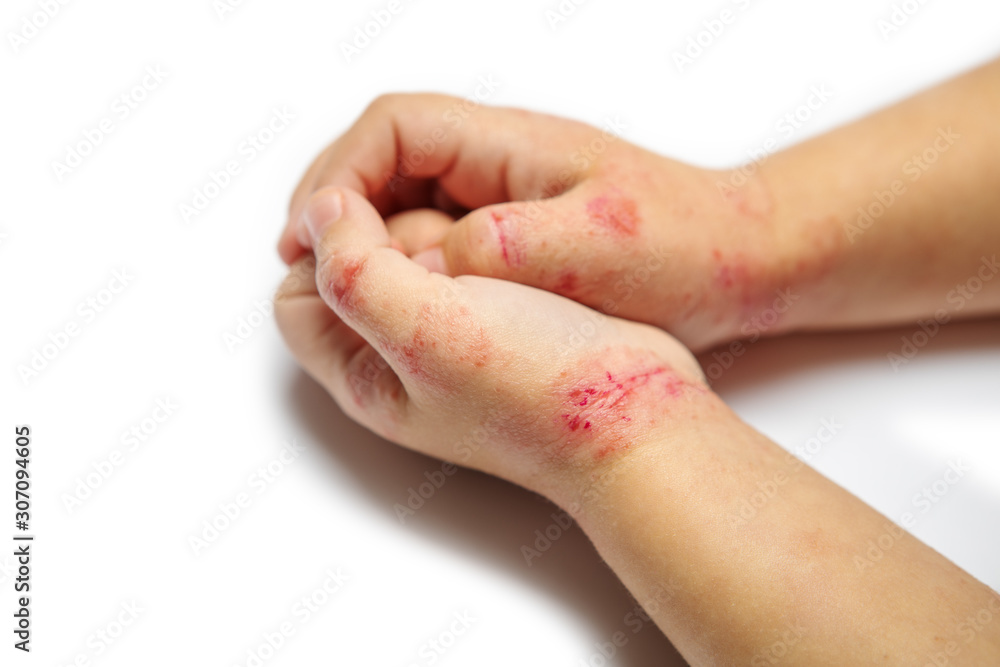 children hand with dermatitis. eczema on hand. Isolated on the white ...