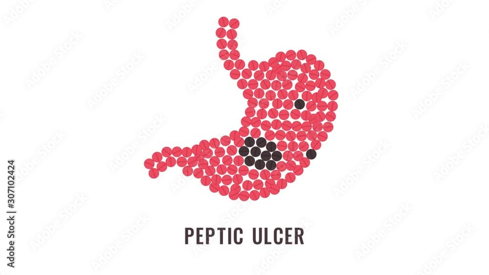 Stomach peptic ulcer awareness cartoon animation with stomach made of ...