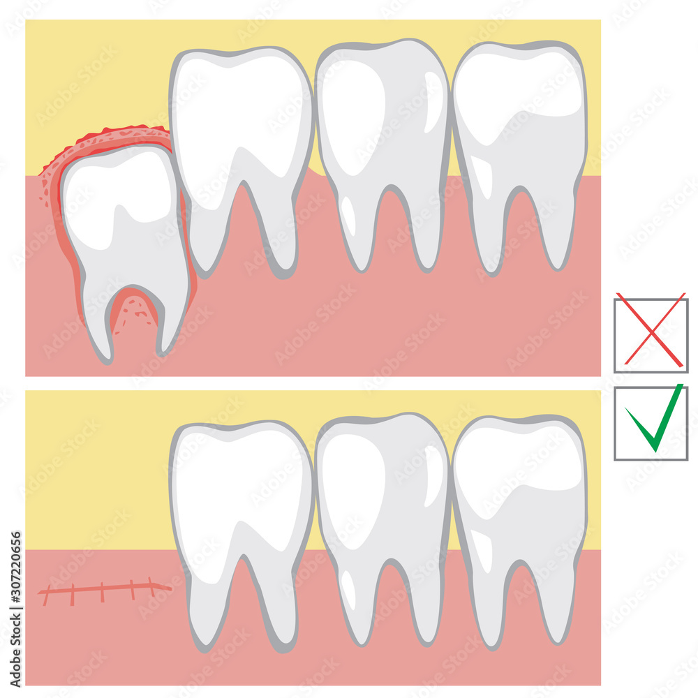 Vetor de Before and after removing a wisdom tooth, a vector stock ...