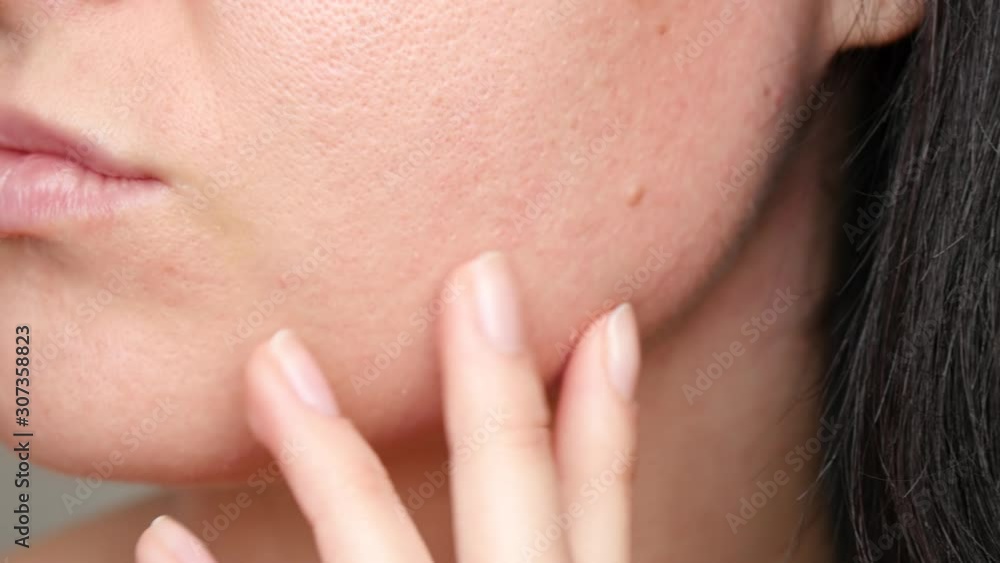 Skin texture with enlarged pores. Close-up of a woman's face. Stock ...