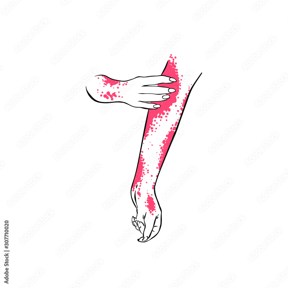 hand drawn sketch of hands with scabies, vector illustration isolated ...