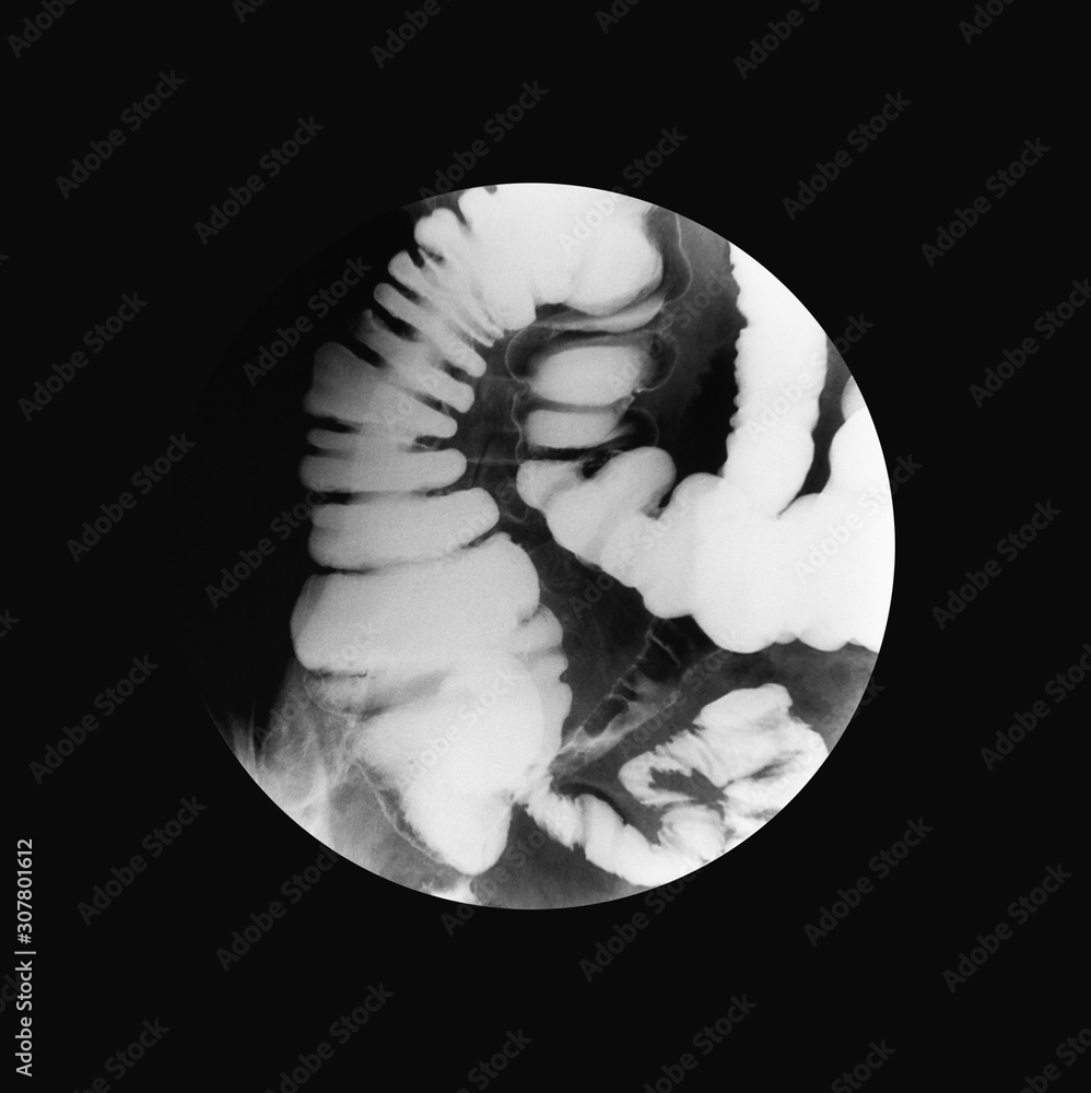 Fluoroscopic examination of lower gastrointestinal (GI) Tract, a spot ...