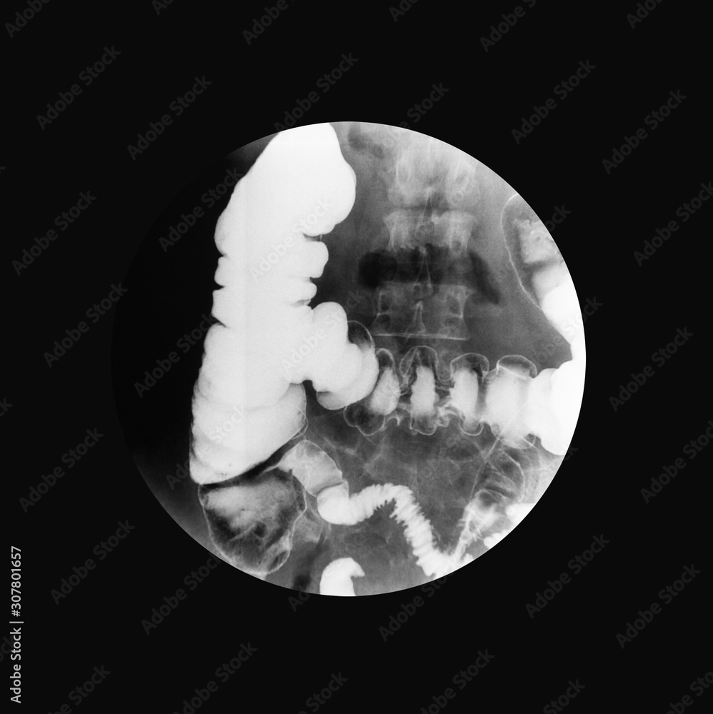 Fluoroscopic examination of lower gastrointestinal (GI) Tract, a spot ...