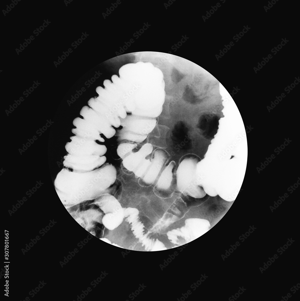 Fluoroscopic examination of lower gastrointestinal (GI) Tract, a spot ...