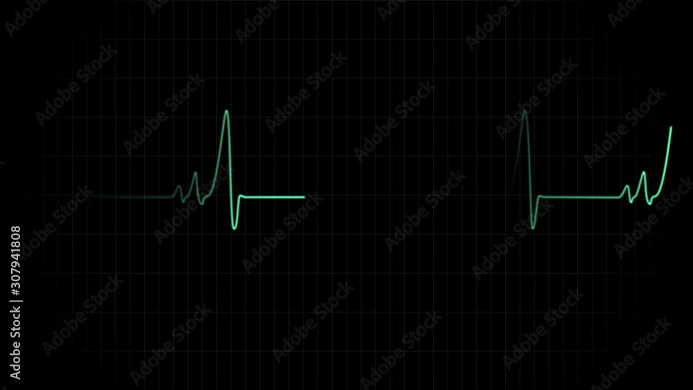 Electrocadiogram (ECG) signals on green graph background with heartbeat ...
