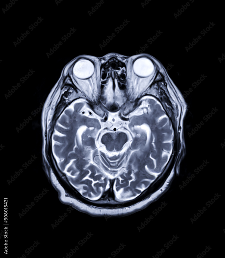 Axial Head Mri Scan