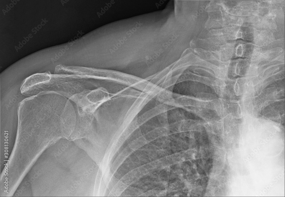 Foto Stock Normal Radiography Of The Shoulder Joint In Direct Foto Stock Normal Radiography Of The Shoulder Joint In Direct