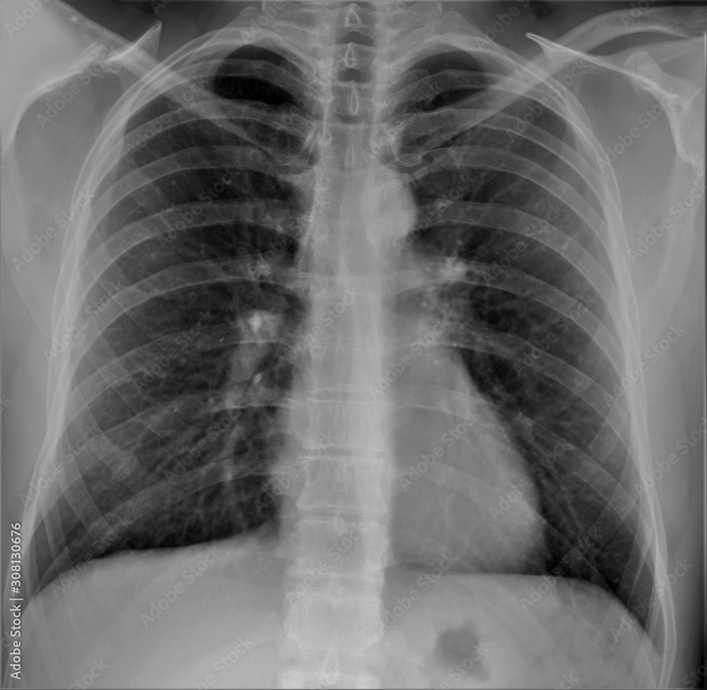 normal radiography of chest organs in direct projection, pulmonology ...