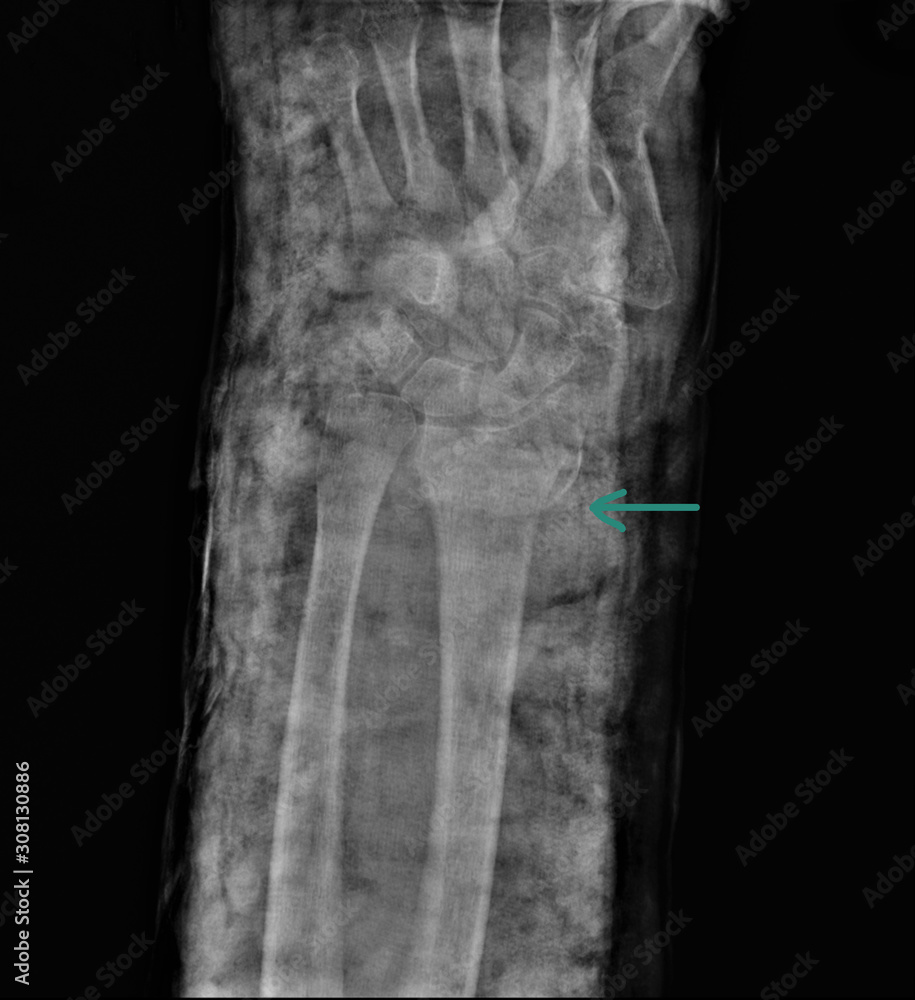 radiography of forearm and wrist bones with a fracture of the distal ...