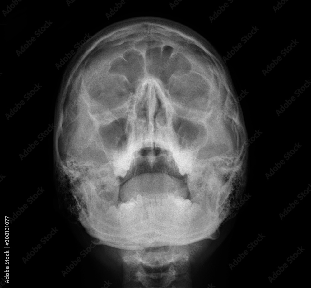 radiography of the paranasal sinuses of the skull, medical diagnosis ...