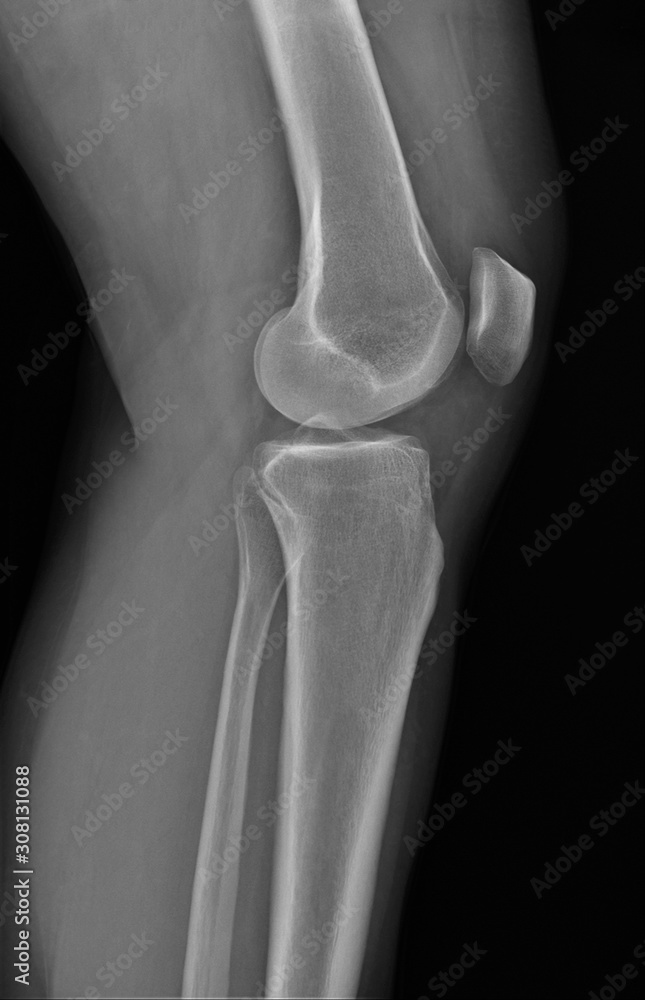 normal radiography of the knee joint in lateral projection, medical ...