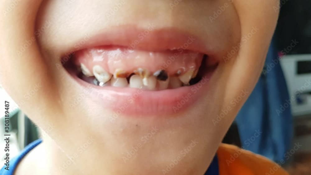 Close up Little child Show Broken teeth boy with a Teeth broken and ...