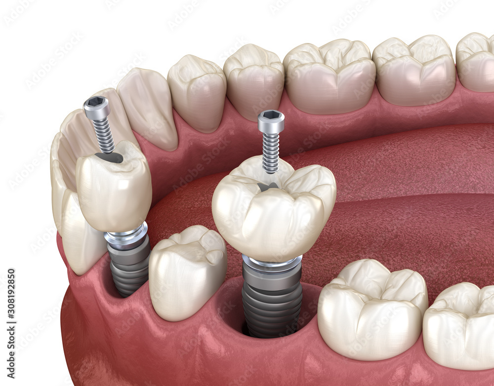 Premolar and Molar tooth crown installation over implant, screw ...