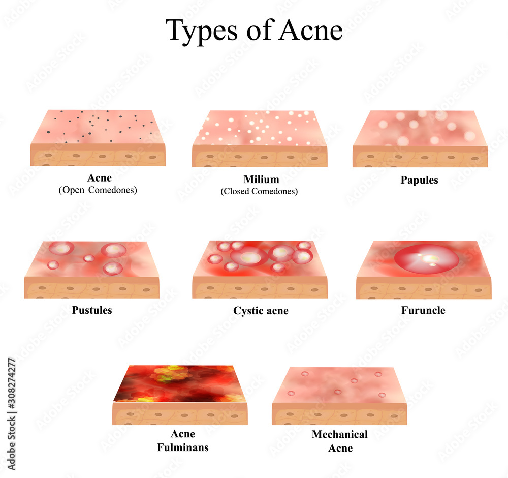 Types Of Acne Skin Inflammation Pimples Boils Whitehead Closed