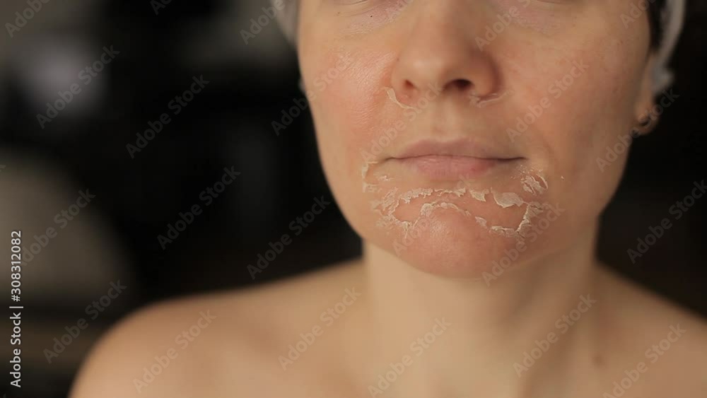 Woman's face after chemical peeling. Peeling skin on the face ...