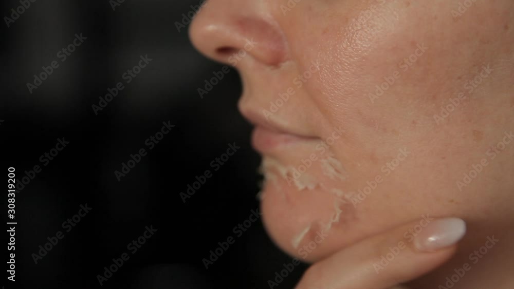 Woman's face after chemical peeling. Peeling skin on the face ...