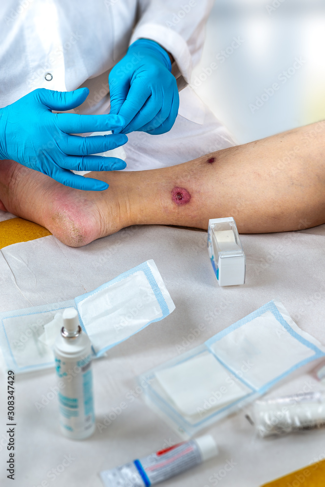 Purulent wound on the skin of a person on the leg close-up.. -Woman ...