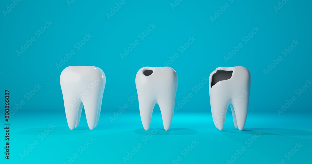 Image of three different teeth: a healthy tooth, teeth with a hole and ...