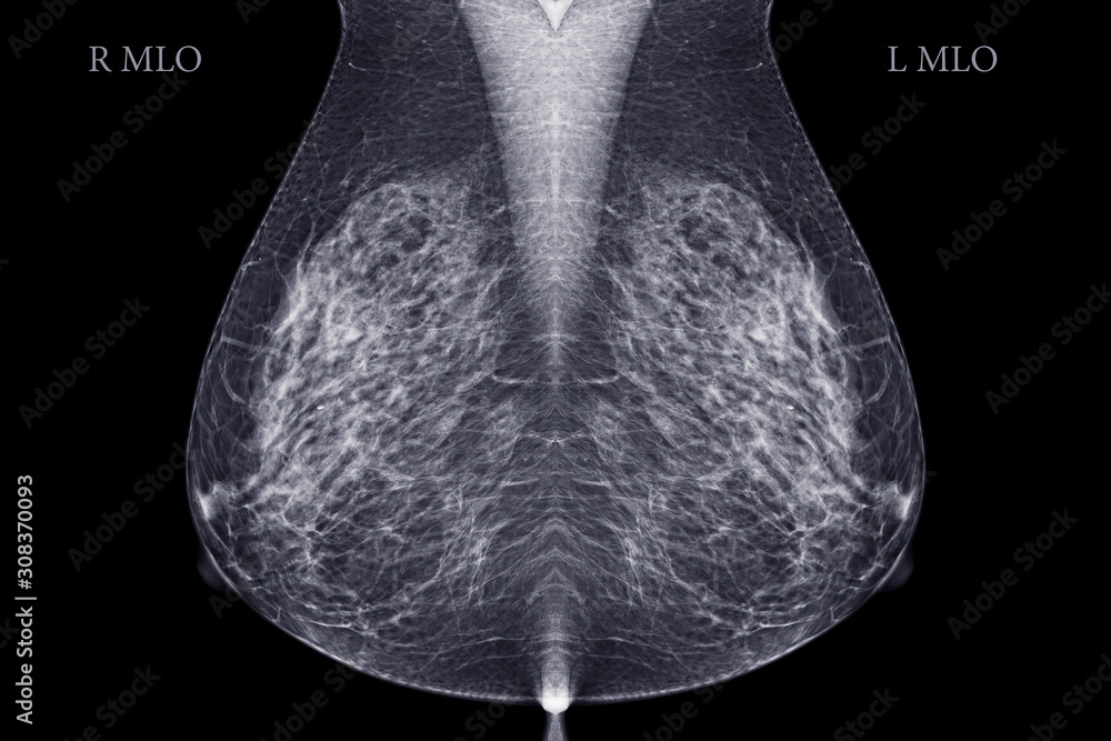 Breast Cancer Digital Mammogram