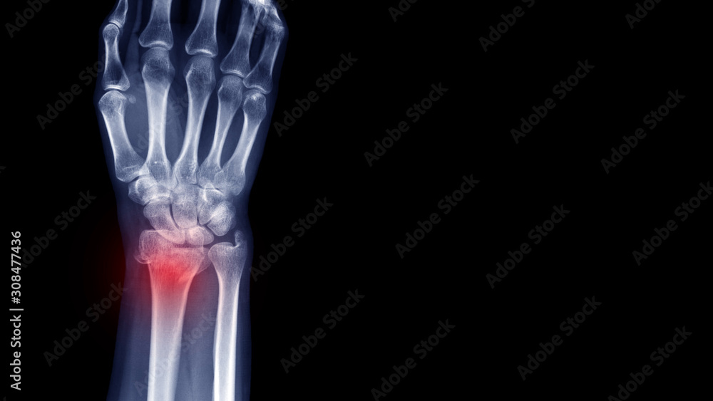 Film X-ray wrist radiograph show lower end of forearm bone broken ...