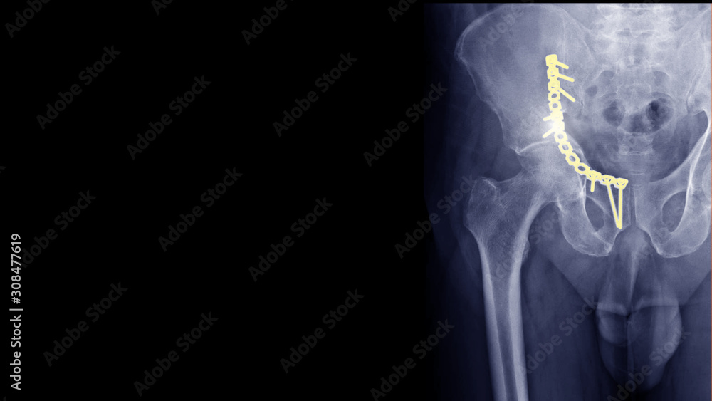 Film X-ray hip radiograph show broken hip bone or acetabular fracture ...